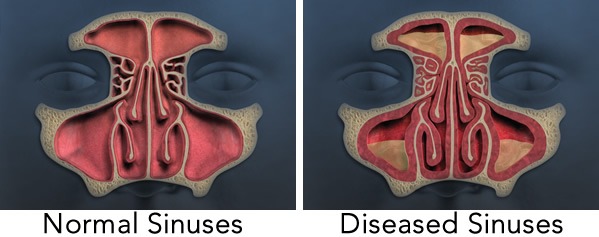 Nasal Stents in Joliet, New Lenox and Morris, Illinois